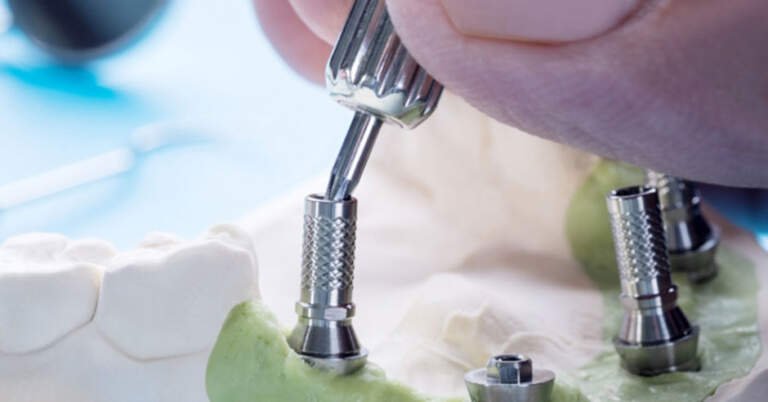 Comparing Abutment Designs: Standard vs. Custom Solutions - European ...